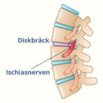 Ischias: bästa sovställning, ischiasnerven, övningar & mer!